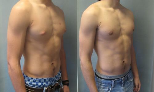 Puffy Nipples In Gay Men Causes And Treatments Gay Health News